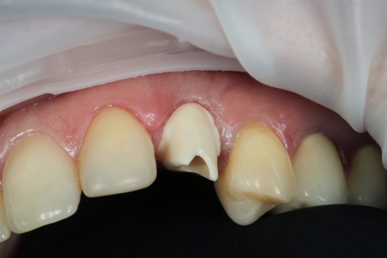 Teilkrone » Kosten, Preisbeispiele und mehr